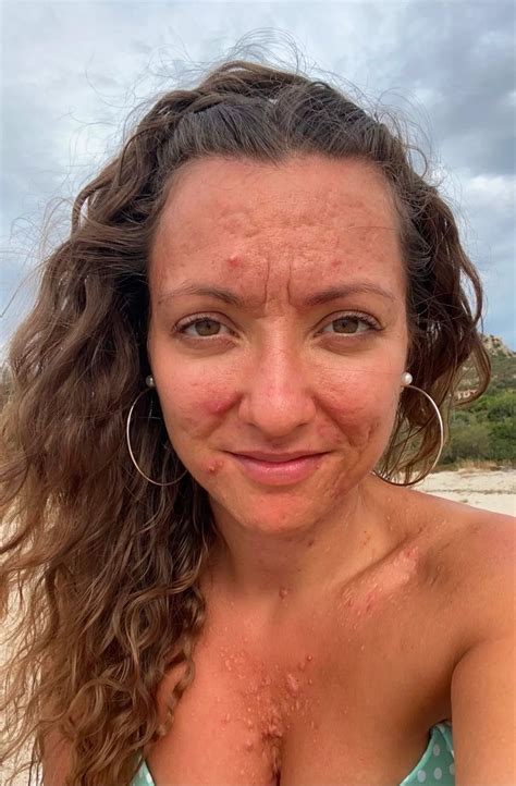 My Acne Was So Bad I Stopped Having Sex But Now Ive Found A