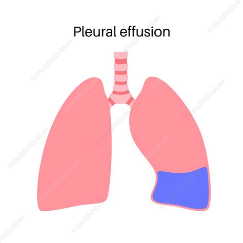 Pleural Effusion Illustration Stock Image F040 2861 Science Photo Library