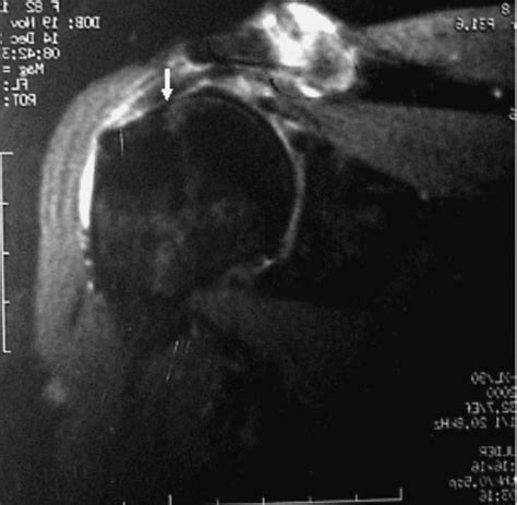 Rotura Del Supraespinoso En Paciente Con Pinzamiento Subacromial Crónico Medicina De Familia