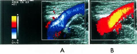 Non Invasive Methods Of Arterial And Venous Assessment PMC