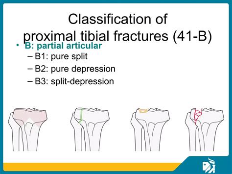 Proximal Tibial Fracture Ppt