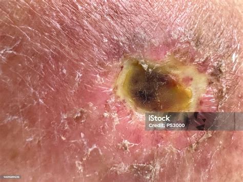 Ulkus Kaki Yang Terinfeksi Ulcus Cruris Foto Stok Unduh Gambar