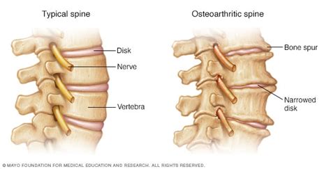 Osteophyte Formation Lumbar Spine