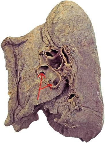 Pa Anatomy Lab Lung Dissection Flashcards Quizlet