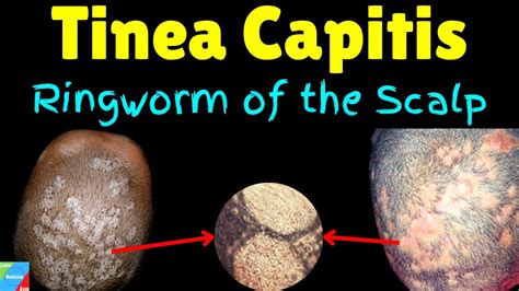 Ringworm Of The Scalp Tinea Capitis Causes Symptoms