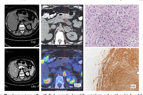 Table 1 From Severe Ectopic Cushings Syndrome Due To Acth Secreting