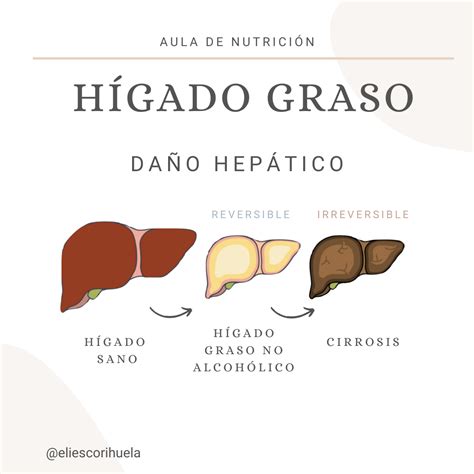 Como Se Desinflama El Higado Graso At Amelie Aurelio Blog