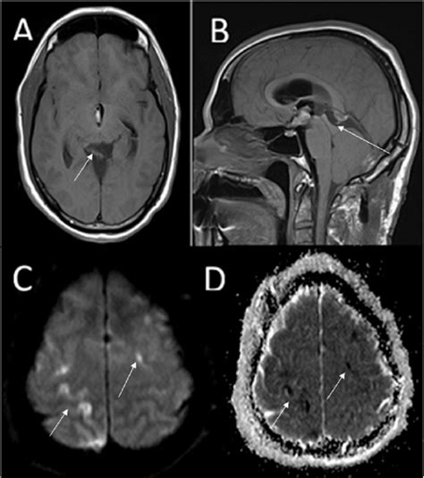 Magnetic Resonance Imaging Mri Axial T1weighted Images