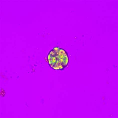 Leucine Crystals Identification And Clinical Significance