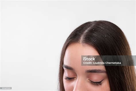 흰색 배경 근접 촬영에 비듬 문제가 있는 여자 텍스트를 위한 공간 25 29세에 대한 스톡 사진 및 기타 이미지 25 29세 갈색 머리 건강관리와 의술 Istock