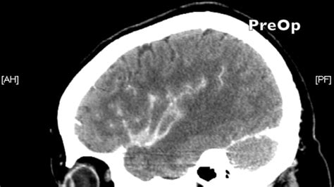 Surgical Neurology International