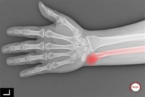 Understanding Ulnar Styloid Fractures Key Insights Into Wrist Injuries Central Health