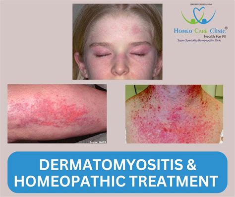 Homeopathic Care For Dermatomyositis Effective Skin Solutions