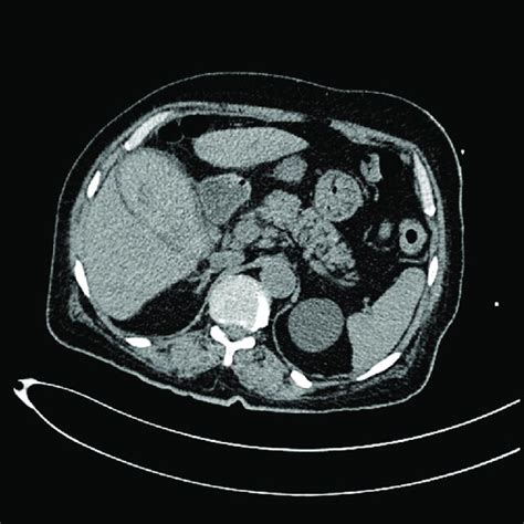 Axial Non Contrast Ct Scan Of The Abdomen Shows Distended Gallbladder Download Scientific