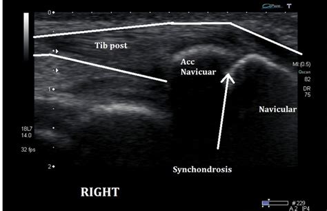 Types Of Accessory Navicular Bone Radiology At Pamela Drake Blog