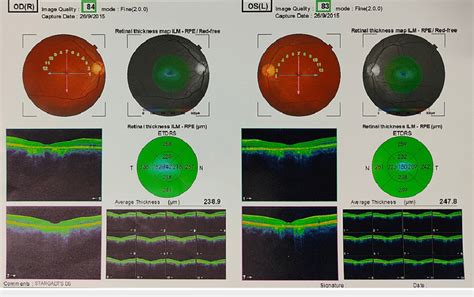 3d Oct Optical Coherence Tomography Of The Patient The Oct Scan Download Scientific Diagram