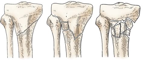 Proximal Tibia Anatomy