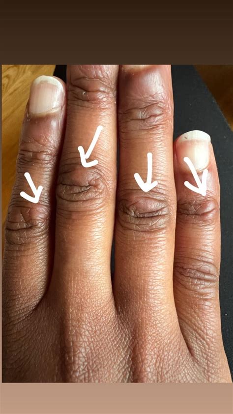 Why Do My Knuckles Look Brown
