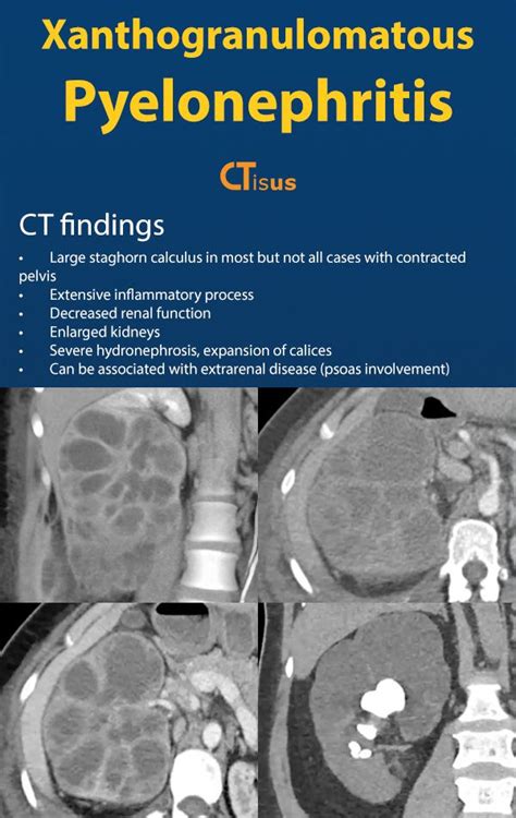Ctisus On Linkedin Xgp Ct Findings