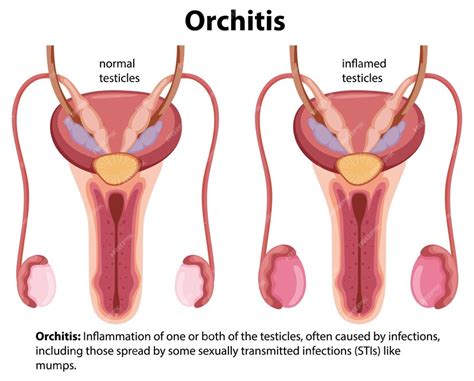 Premium Vector Male Orchitis Testis Infographic Illustration