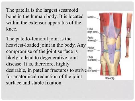 Fracture Of Patella Pptx