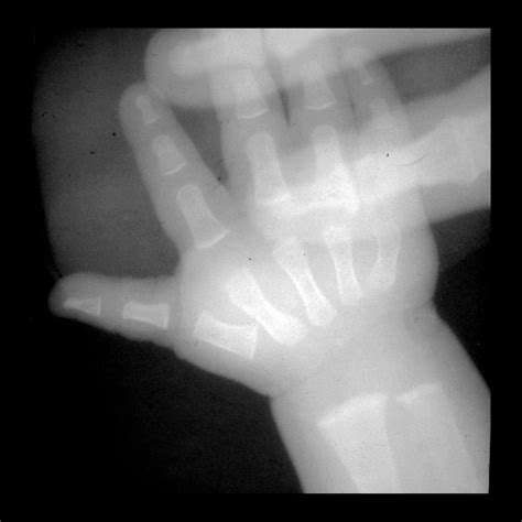 Congenitalhypothyroidism01tchdwarfhandzm Pediatric Radiology Case