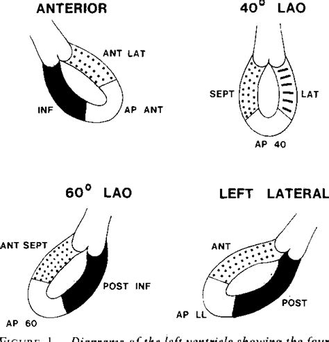 Figure 1 From Exercise‐induced St‐segment Elevation In Leads V1 Or Avl A Predictor Of Anterior