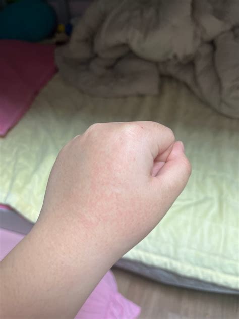 핸드크림 붉은 반점 지식in