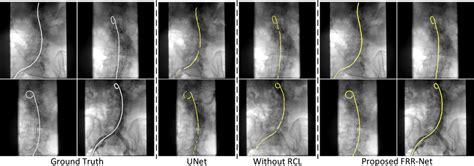 Qualitative Analysis Catheter Segmentation And Tracking Results Of