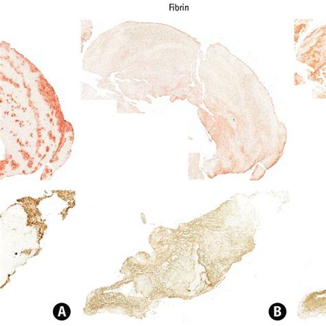 Thrombus Composition And Etiology Of Stroke Download Scientific Diagram