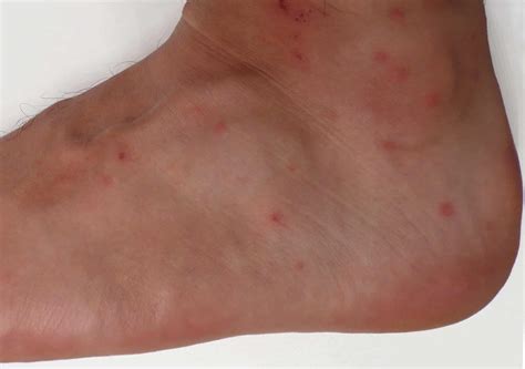 Clover Mites Vs Chiggers 4 Key Differences Between These Little Pests
