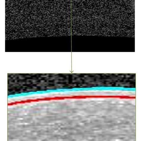 An Example Of Segmented Corneal Image The Epithelium Boundary Cyan