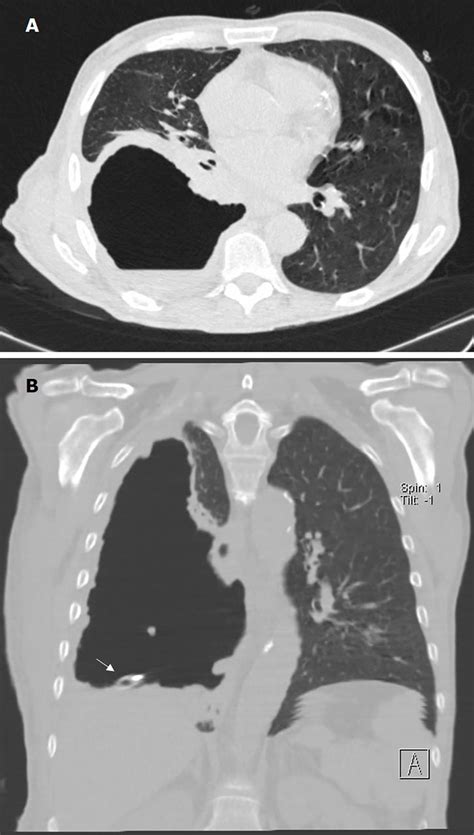 Giant Abscess