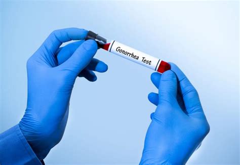 Gonorrhea Prevention And Treatment Facts To Know Step To Health