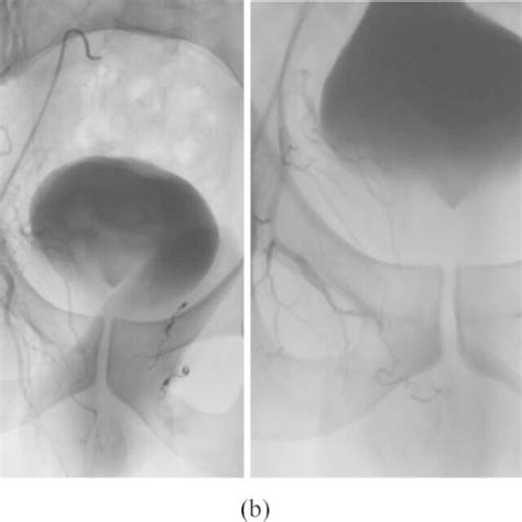 Selective Angiography Of The Right Internal Iliac Artery Showed Normal