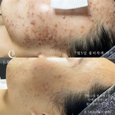 군산피부관리 군산여드름관리 군산콜드플라즈마 군산슈퍼젝션 군산웨딩관리 군산신부관리 군산피부창업반 요새 잘 나가는 케어 중