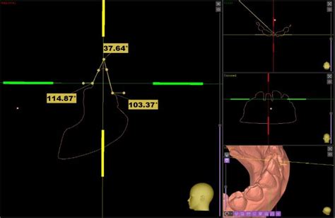 Determination Of 37 64°convergence Angle On Up Per Incisor From Labial