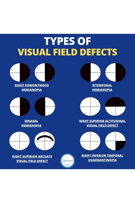 visual field defects optometry optometry education optometry
