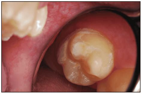 Smooth Surface Dental Caries And Decalcification Restoration And Reinforced Sealant Application