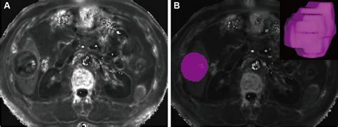 Figure 2 From Radiomics Analysis Of R2 Maps To Predict Early Recurrence Of Single