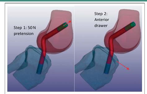Figure 1 From The Hybrid Transtibial Technique For Femoral Tunnel Drilling In Anterior Cruciate
