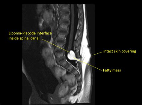 Lipomyelocele