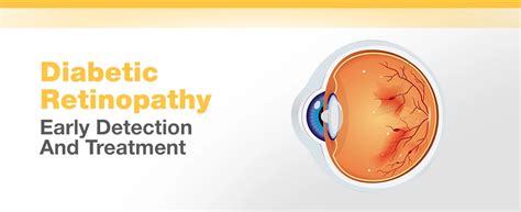 Diabetic Retinopathy Early Detection And Treatment Wavikar Eye Institute