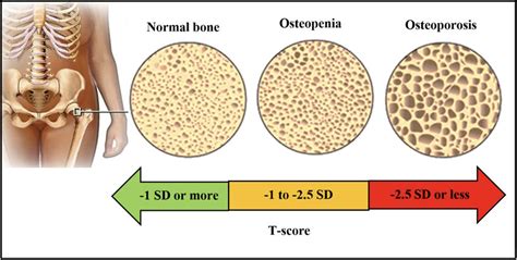 Apa Itu Osteopenia Klinik Tulang Belakang