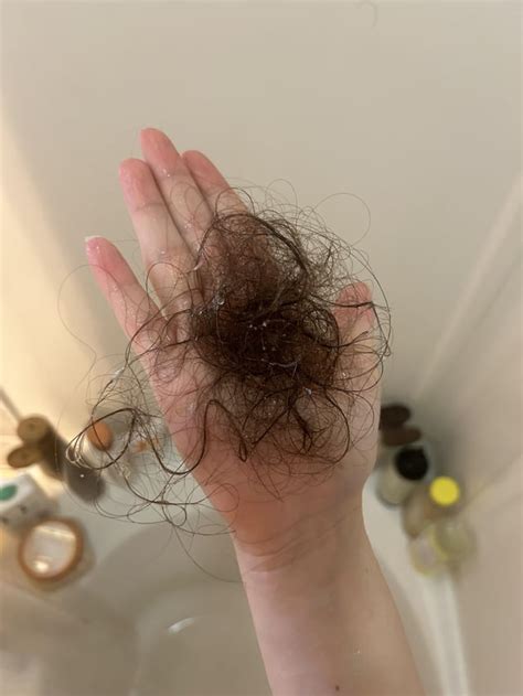 Major Hair Loss Help Rwellbutrinbupropion
