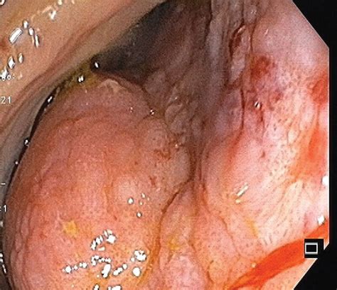 Colonoscopy Showing Large Growth In Ascending Colon Download Scientific Diagram