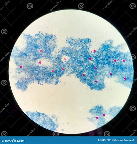Cryptococcus Neoformans In Lung Tissue Warthin Starry Silver Stain