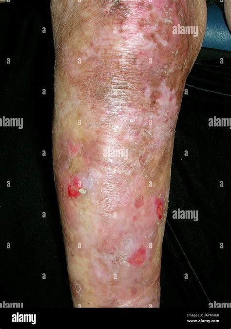 Epidermolysis Bullosa Eb Blister On The Leg Of A 31 Year Old Female