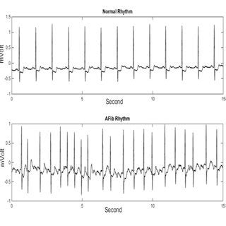 PDF False Alarm Reduction In Atrial Fibrillation Detection Using Deep Belief Networks