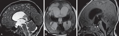 Hydrocephalus And Other Cerebrospinal Fluid Disorders Clinical Tree